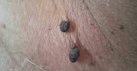 Apa Itu Skin Tag? Ini Dia Penyebab dan Cara Mengatasinya | Popmama.com