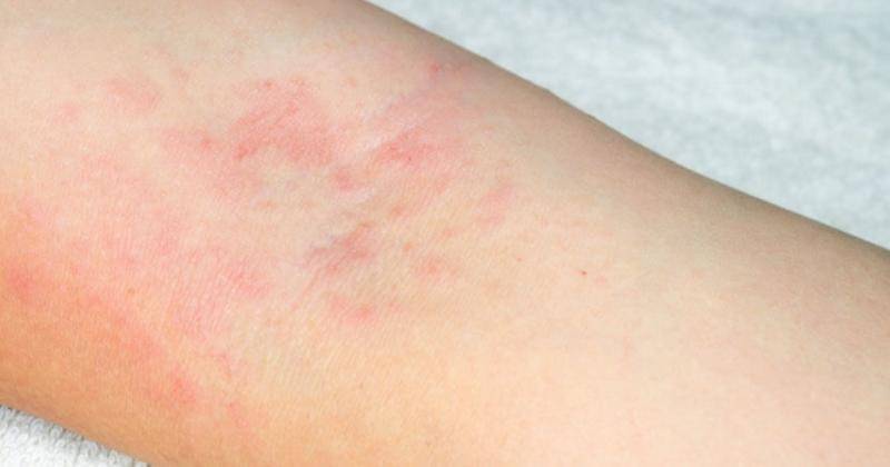 Ini Dia Obat Sarampa Penyakit yang Menyebabkan Ruam di Kulit | Popmama.com