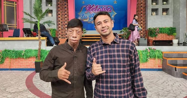 6 Fakta Keluarga Surya Manurung, Mengidap Sindrom Langka | Popmama.com