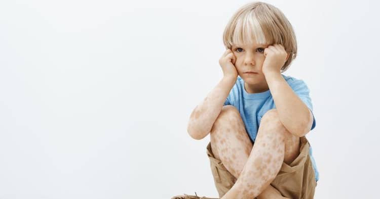 Pityriasis Alba, Penyebab, Gejala, dan Pengobatan pada Anak | Popmama.com