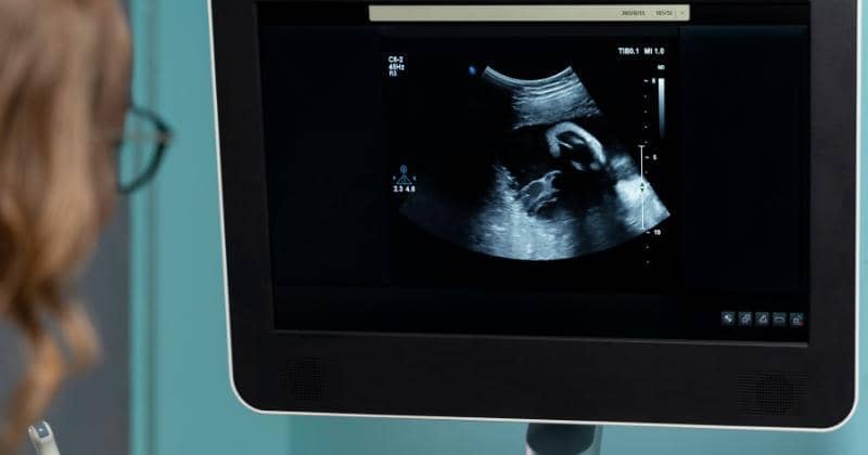 Cara Membaca Hasil USG 4D yang Tepat, Ibu Hamil Wajib Tahu! | Popmama.com