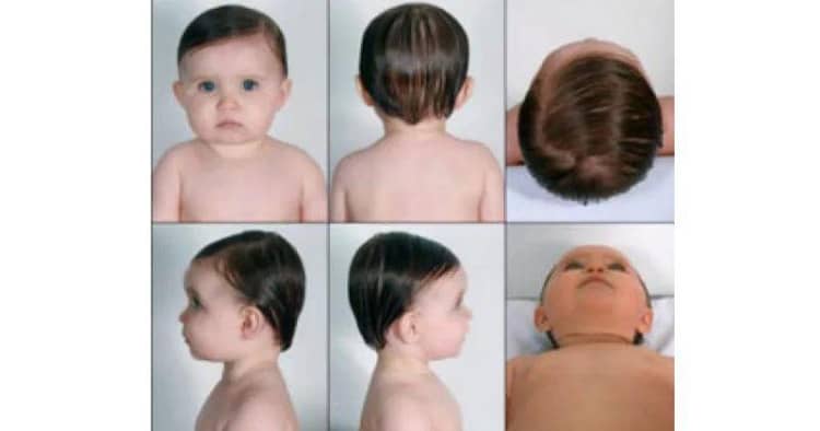 Kenali Bentuk Kepala Bayi Normal Sesuai Usia | Popmama.com