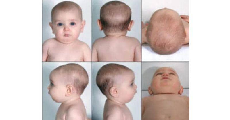 Kenali Bentuk Kepala Bayi Normal Sesuai Usia | Popmama.com