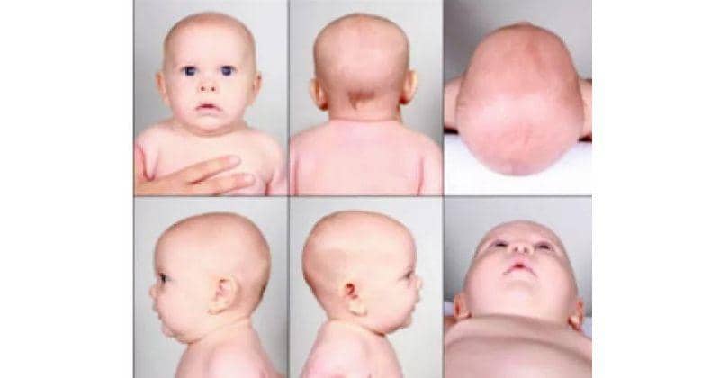 Kenali Bentuk Kepala Bayi Normal Sesuai Usia | Popmama.com