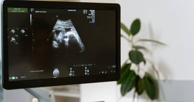 Apa Bedanya USG Biasa dengan USG Fetomaternal? | Popmama.com