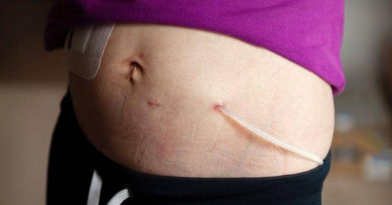 Apa itu Cuci Perut atau CAPD? | Popmama.com