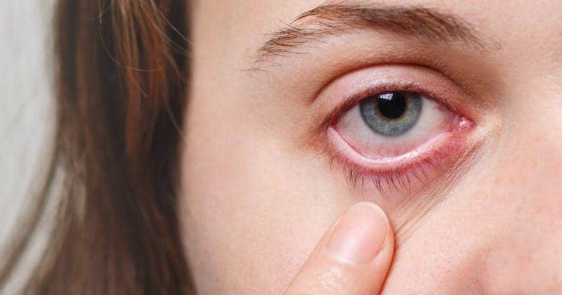 10 Penyebab Mata Terasa Mengganjal, Jangan Anggap Sepele! | Popmama.com