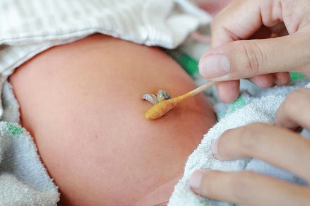 Kenapa Pusar Bayi Berdarah setelah Puput? Ini Penjelasannya | Popmama.com
