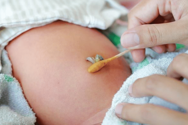 Kenapa Pusar Bayi Berdarah setelah Puput? Ini Penjelasannya | Popmama.com