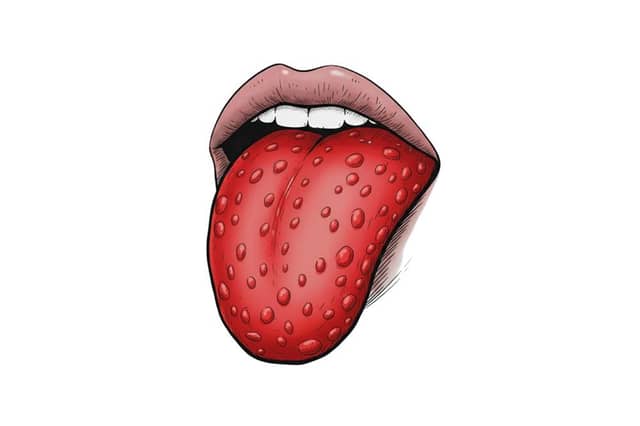 7 Warna Lidah Bisa Ungkap Kondisi Kesehatan, Waspadai Tanda Ini ...